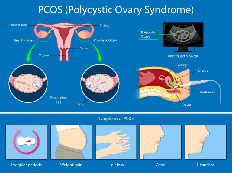 Fibroid Uterus & PCOS Treatment - Dr.Sawant Clinic Mother & Child Care
